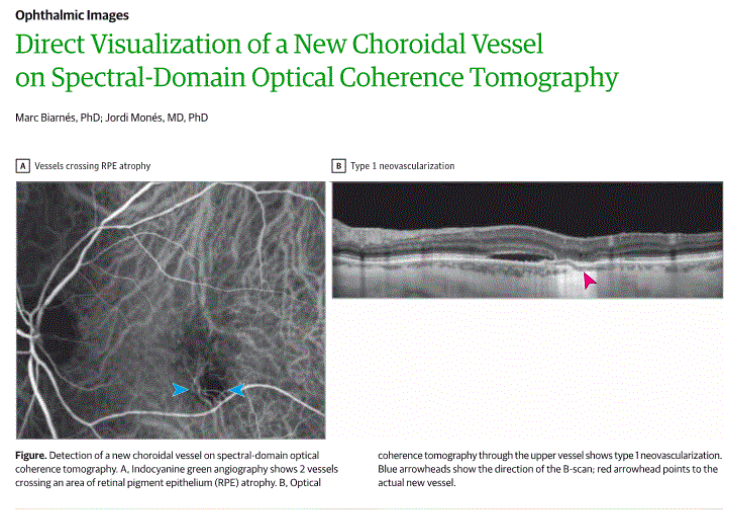 Direct Visualization of a New Choroidal Vessel on Spectral-Domain ...
